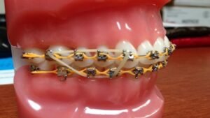 Orthodontic Molar Bands: The Ultimate Guide For 2023