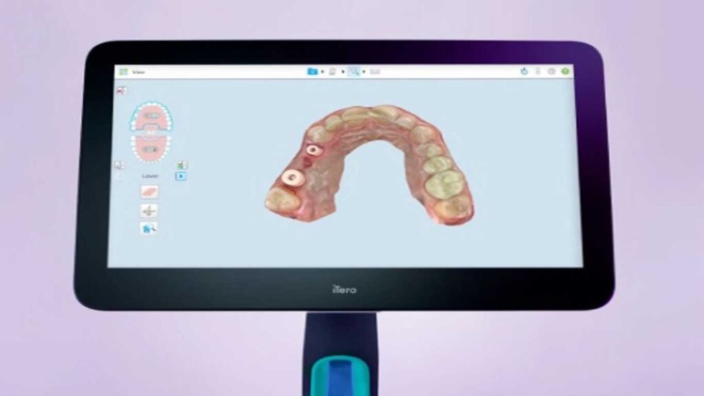 ITERO Invisalign Scanner: 3D Orthodontic Imaging In 2023