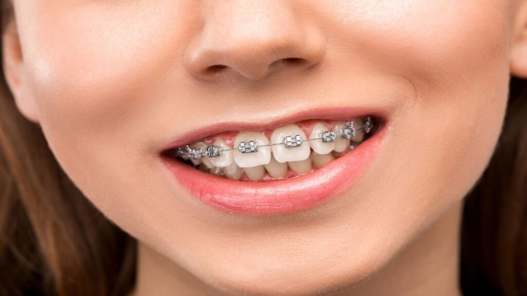 2025 Traditional Braces: Costs, Types, And Pain