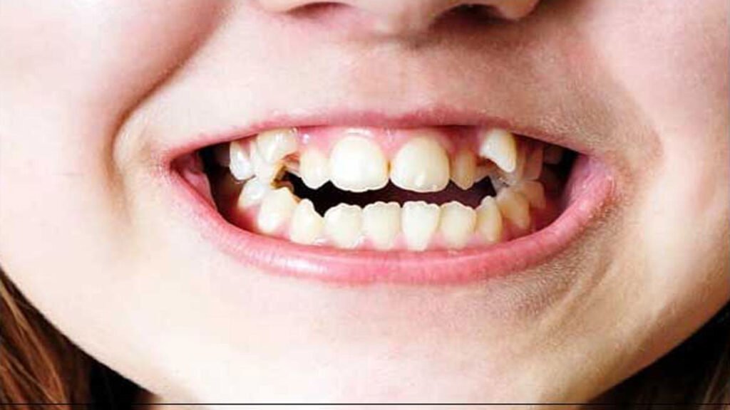 Can Invisalign Fix Snaggletooth- 2023 Invisalign's Power