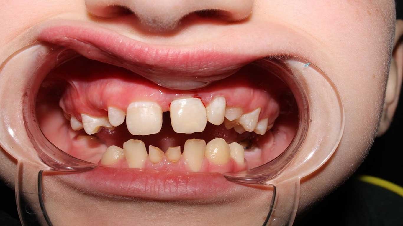 Bye Teeth Crooked: 2024's My Confident Smile Year