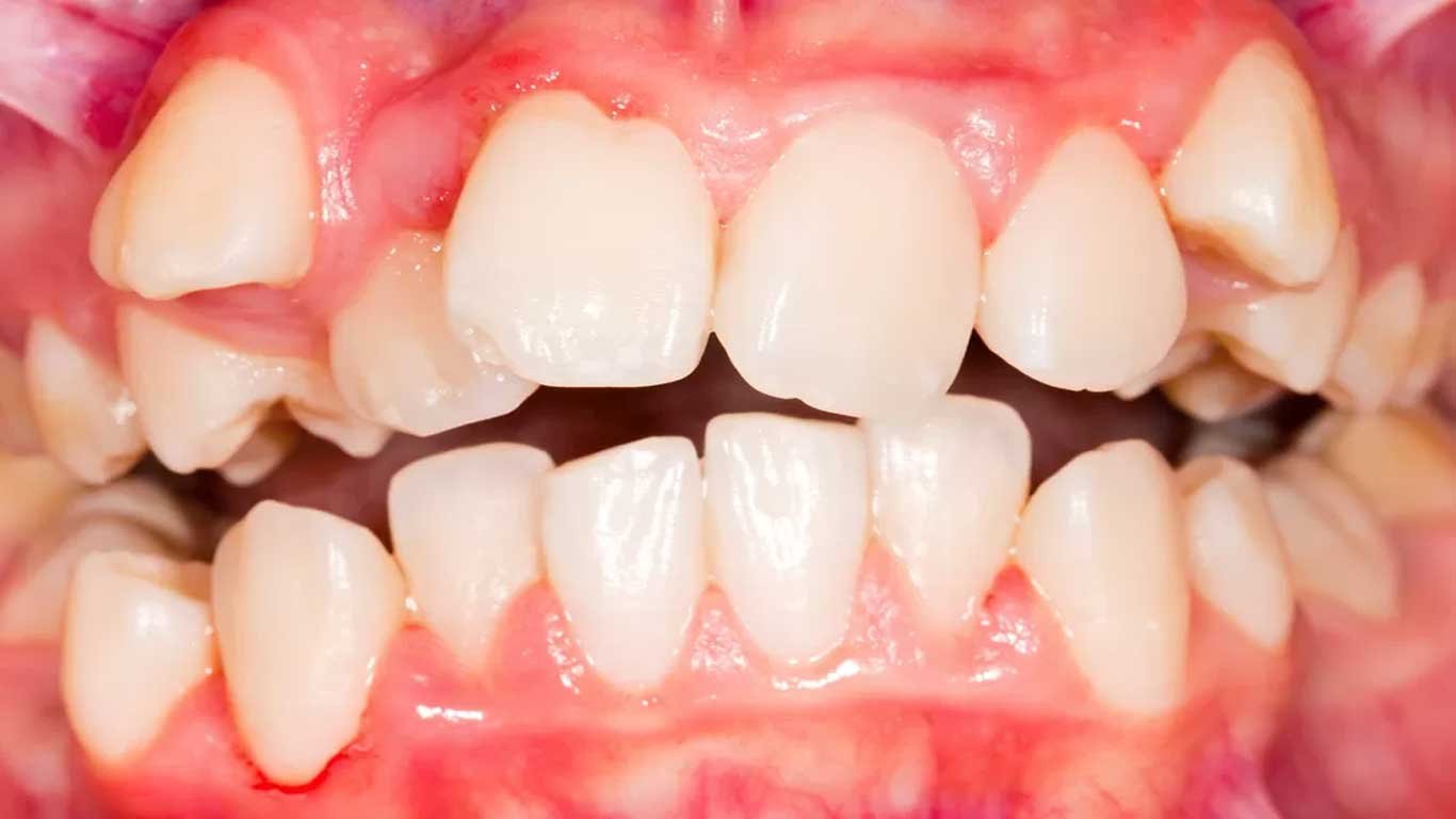 Orthodontic Trends 2024: Malocclusion Problems