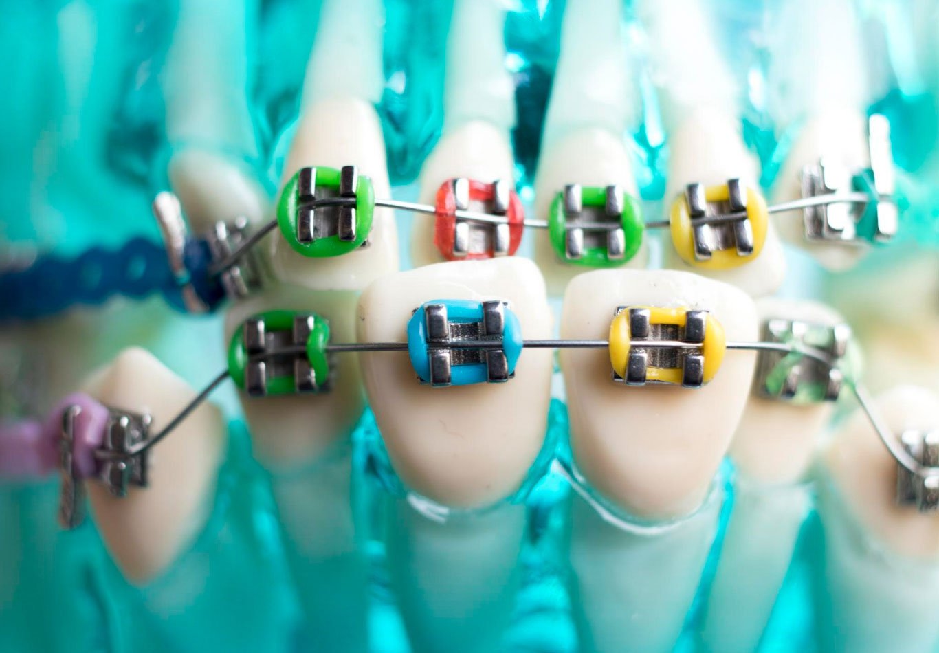 Orthodontic Emergency- Care And Repair