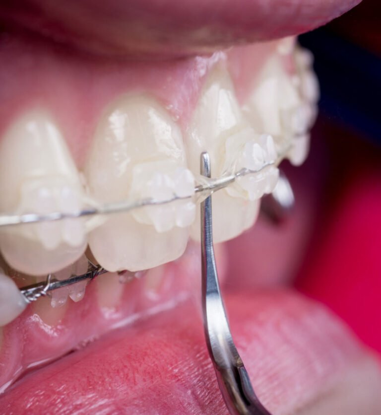 Clear Braces (Ceramic Braces) - Orthodontic Services